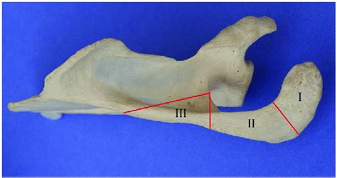 Levy Classification 46 Of Scapula Spine Fractures Associated With Download Scientific Diagram