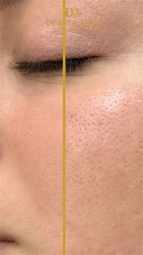 Dr Pimple Popper S Fix For Large Pores Acne Artofit