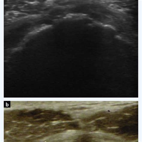Bigliani S Classification Of Acromion Undersurface With Corresponding