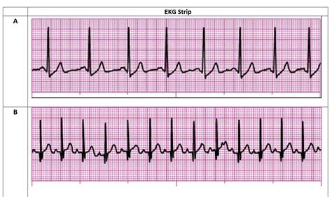 Ekg Interpretation 6 Diagram Quizlet