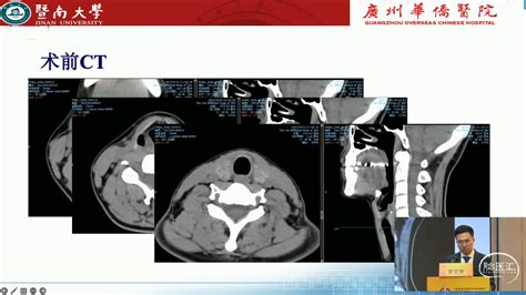 曹艺耀医生：硬膜下超选择性神经根切断术治疗痉挛性斜颈的效果初探 脑医汇