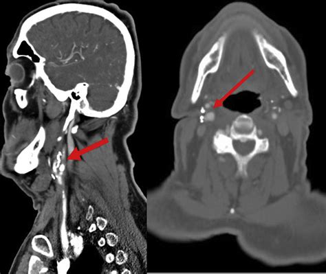 Bilateral Carotid Patch Infection Occurring 12 Years Following