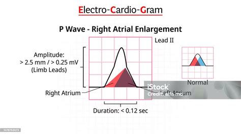 P Wave Ecg Right Atrial Enlargement Hypertrophy Electrocardiogram