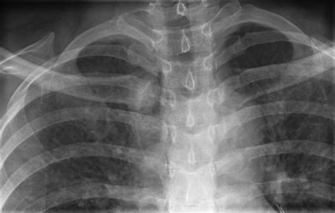 Sternoclavicular Joint Rx Sternoclavicular Sc Joint Dislocations