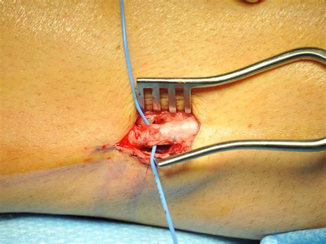 Femoral Popliteal Bypass Revision Vascular And Vein