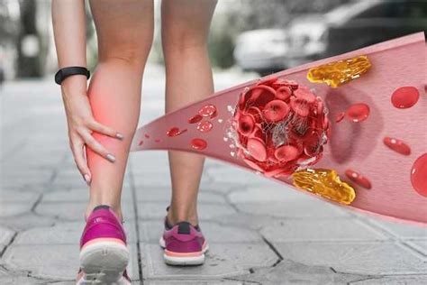 Как избавиться от сосудистых звездочек на ногах: эффективные методы ...