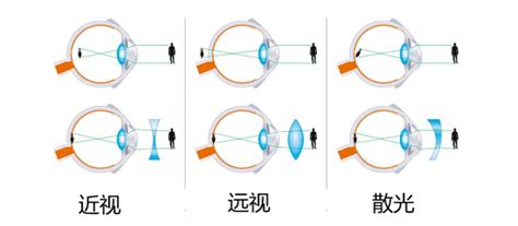 散光眼是怎么形成的360新知