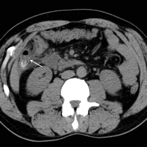 Non Contrast Abdominal Ct Shows Subhepatic Dilated Appendix With Wall
