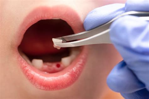 Tooth Removal Atharva Dental Clinic
