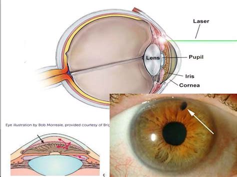 Primary Closed Angle Glaucoma Acute Congestive Glaucoma Pptx