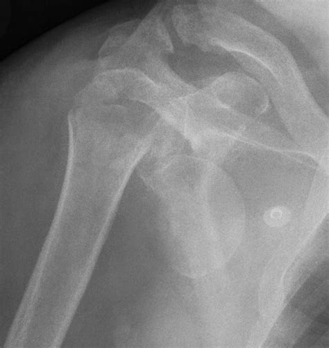 Proximal Humerus Fracture The Bone Babe