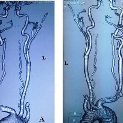 Absent Flow In V3 V4 Segment Of Left Vertebral Artery Download