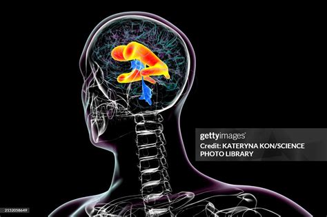 Enlarged Lateral Ventricles Of The Brain Illustration Ilustración De