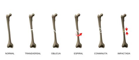 Fractura O Fisura ósea Fisioterapia Vitae