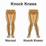Demystifying Knocked Knees Causes Treatment And Exercises