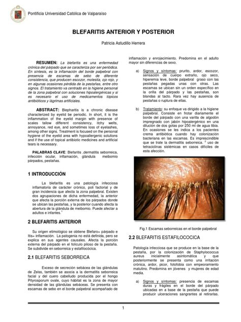 Blefaritis Anterior Y Posterior Pdf Inmunología Enfermedades Y