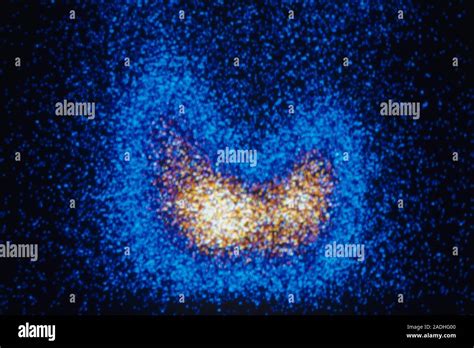 Goitre Coloured Scintigram Of An Enlarged Thyroid Gland Goitre The Thyroid Is An Endocrine