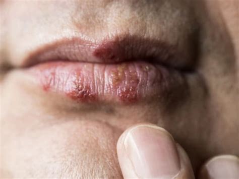 Buy Valtrex Online For Shingles Herpes Simplex Virus Genital Herpes