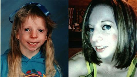 ‘i Was Benched And Pushed To The Side Woman With Treacher Collins