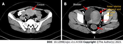 Computerized Tomography Imaging A Uterine Body B Lower Uterine