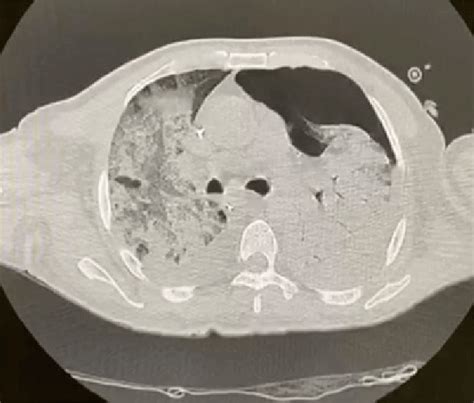 Chest Ct Scan Showing Bilateral Air Bronchogram In The Lungs