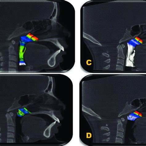 A B Preoperative Scan C D Postoperative Scan Showing The Effect Of Download Scientific