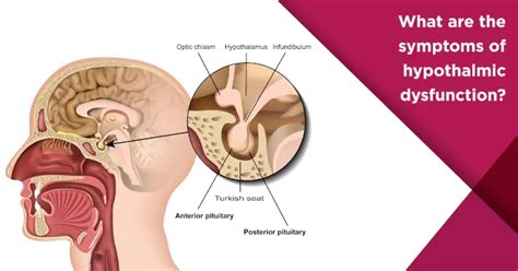 Hypothalamic Dysfunction