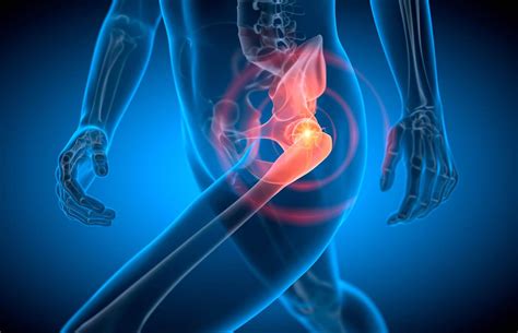 Hip Bursitis Diagnosis Treatment And Recovery