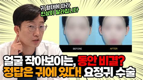 누운귀 교정 부작용 없는 완벽한 요정귀 만들기 Youtube