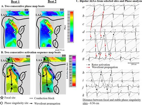 A Representative Example Patient 10 Showing Conduction Block