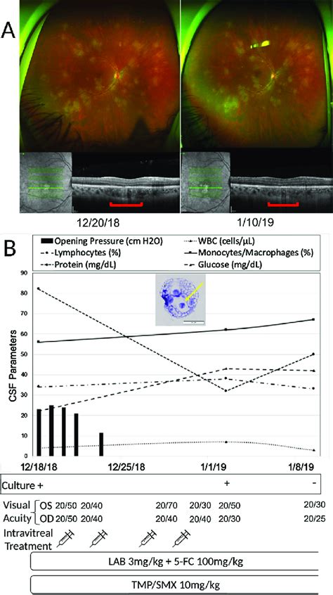 Timeline Of Opening Pressure And CSF Results CSF Culture Visual Download Scientific Diagram