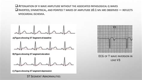 Myocardial Infarction Introduction Clinical Manifestation