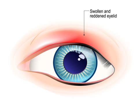 Eye Styes Causes Symptoms And 5 Ways To Get Rid Of Them