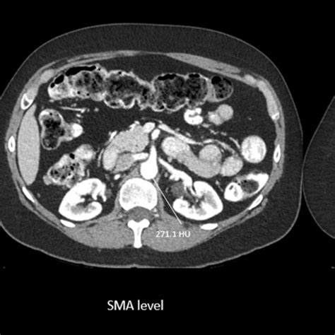 Clinical Example For Quantitative Measurement For All Reconstructions Download Scientific