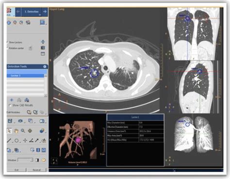 Computer Aided Detection Of Chest Nodules Philips 2018 Download Scientific Diagram