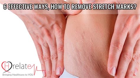 6 Effective Ways On How To Remove Stretch Marks