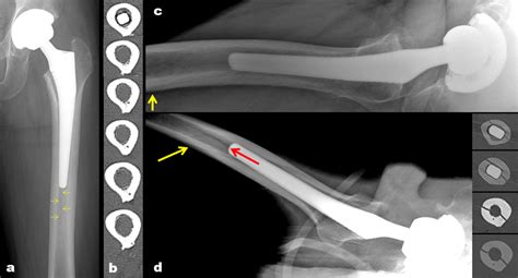 We Defined Nutrient Artery Canal Of The Femur Yellow Arrow As A A
