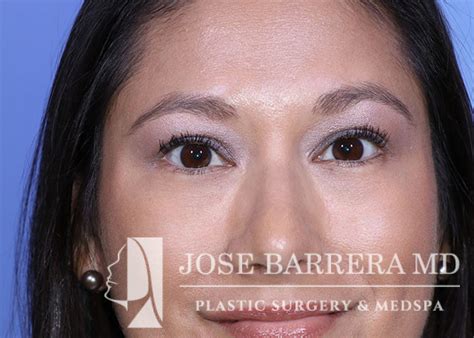 Blepharoplasty Case 20821 Dr Jose Barrera San Antonio Facial Plastic Surgeon ENT