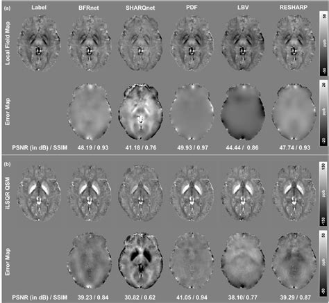 Bfrnet A Deep Learning Based Mr Background Field Removal Method For Qsm Of The Brain Containing