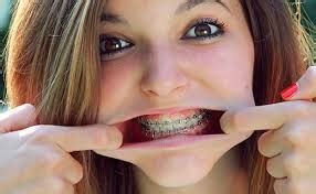 How To Fix An Overbite At Home