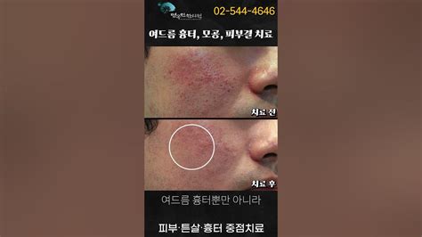 여드름 흉터 모공 피부결 치료잘하는 피부한의원 피부 튼살 흉터 중점 치료 명옥헌 한의원 Youtube