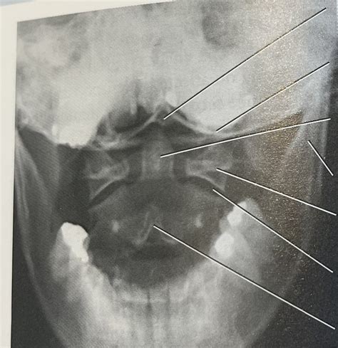 Label Odontoid Diagram Quizlet Label Odontoid Diagram Quizlet