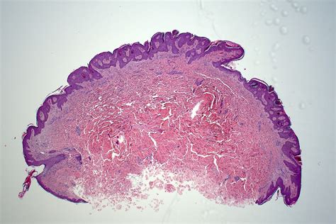 Verruca Plantaris Pathology Outlines