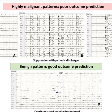 Highly Malignant And Benign Eeg Patterns Adapted From Westhall Et Al Download Scientific