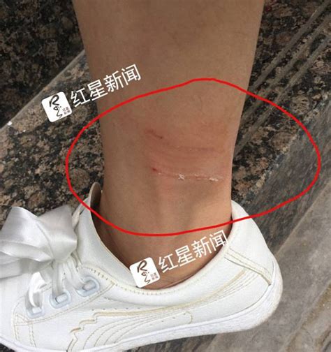 女子被狗咬按时打针仍死亡 丈夫质问为何疫苗没用 手机凤凰网