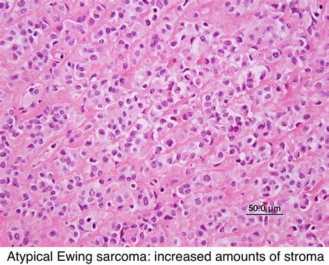 Pathology Outlines Ewing Sarcoma Pnet