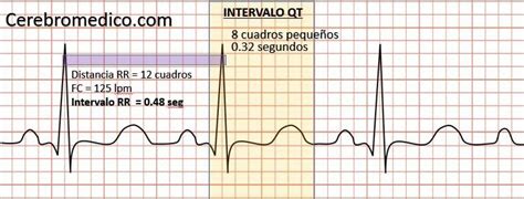 Analsis Del Intervalo QT Como Calcular El Intervalo QTc