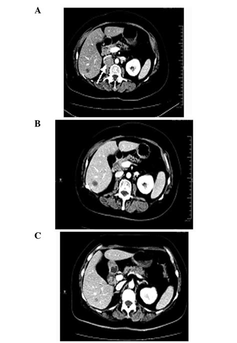 Ct Scan Revealing A Local Recurrences In The Retroperitoneum And B