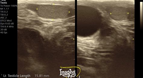 Case 82 Encysted Hydrocele Of The Spermatic Cord ~ Imaging Study