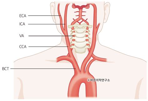 경동맥 초음파 Carotid Ultrasonography Metamedic